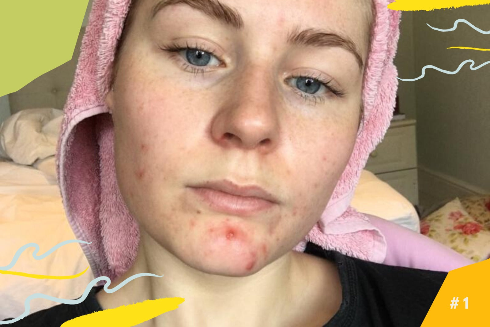 #UPLIFT - Acne – Urban Veda